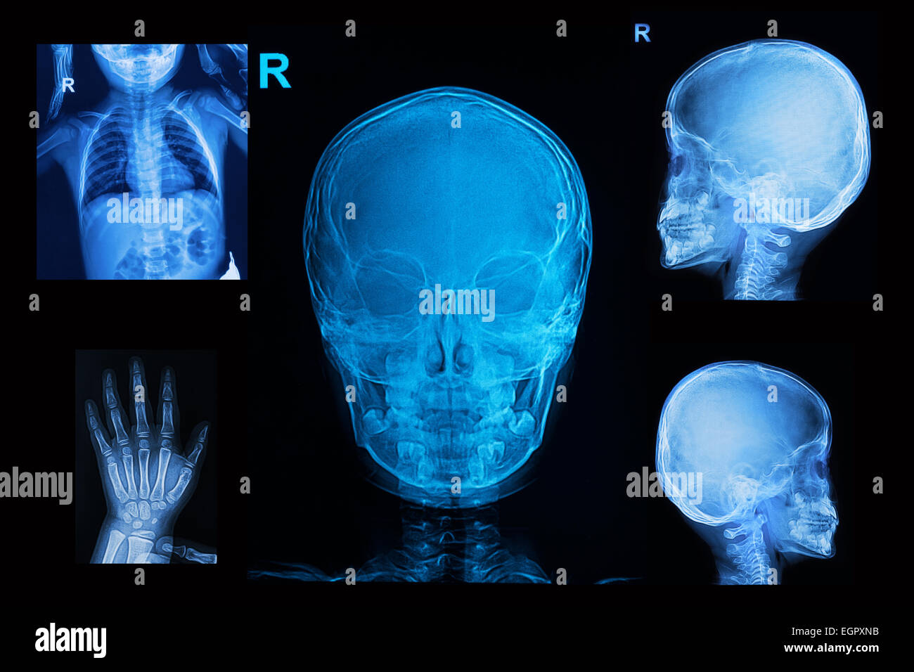 Child hand x ray -Fotos und -Bildmaterial in hoher Auflösung – Alamy