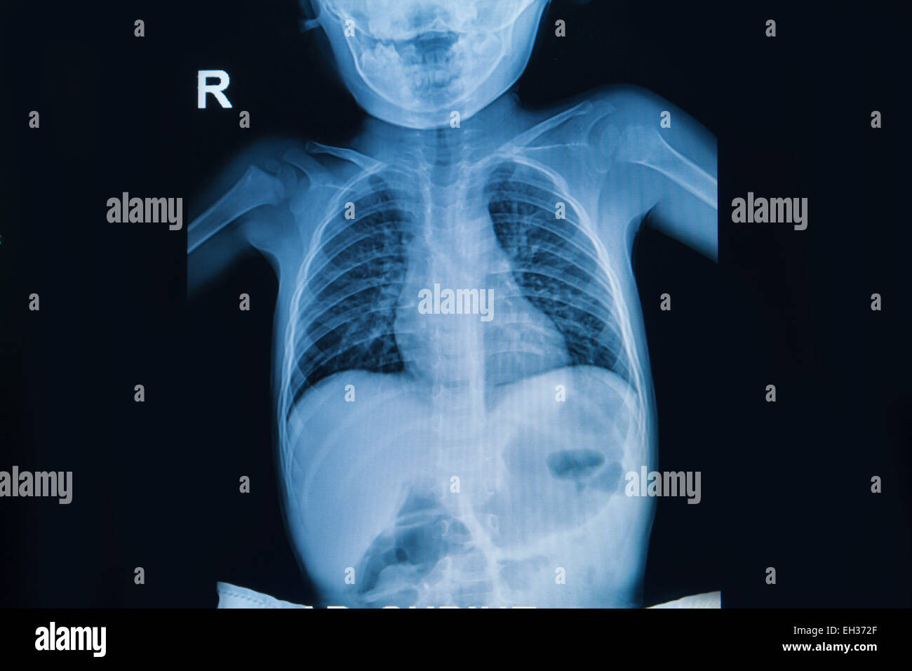 Chest X Ray Stockfotos & Chest X Ray Bilder - Alamy