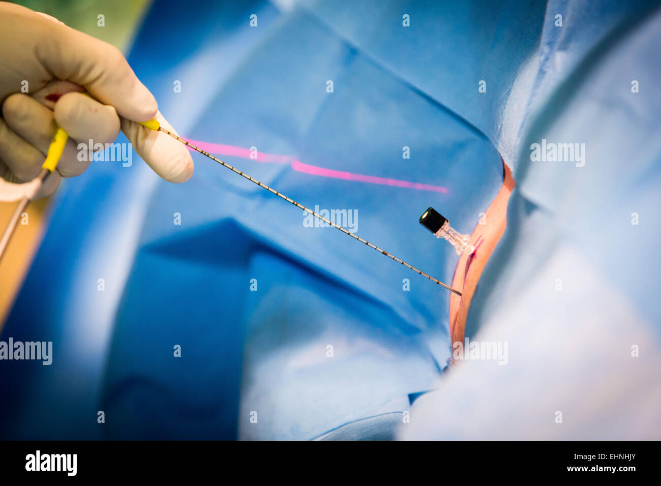 CT-Scan-gestützte Kryotherapie zu zerstören einen Nierentumor, Saint ...