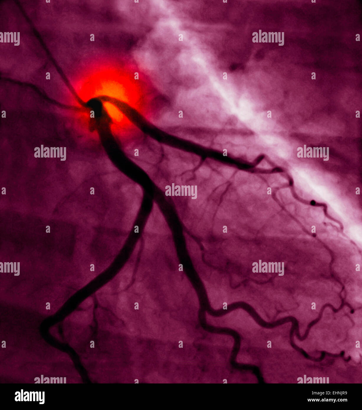 Koronare Herzerkrankung Stockfotos & Koronare Herzerkrankung Bilder - Alamy