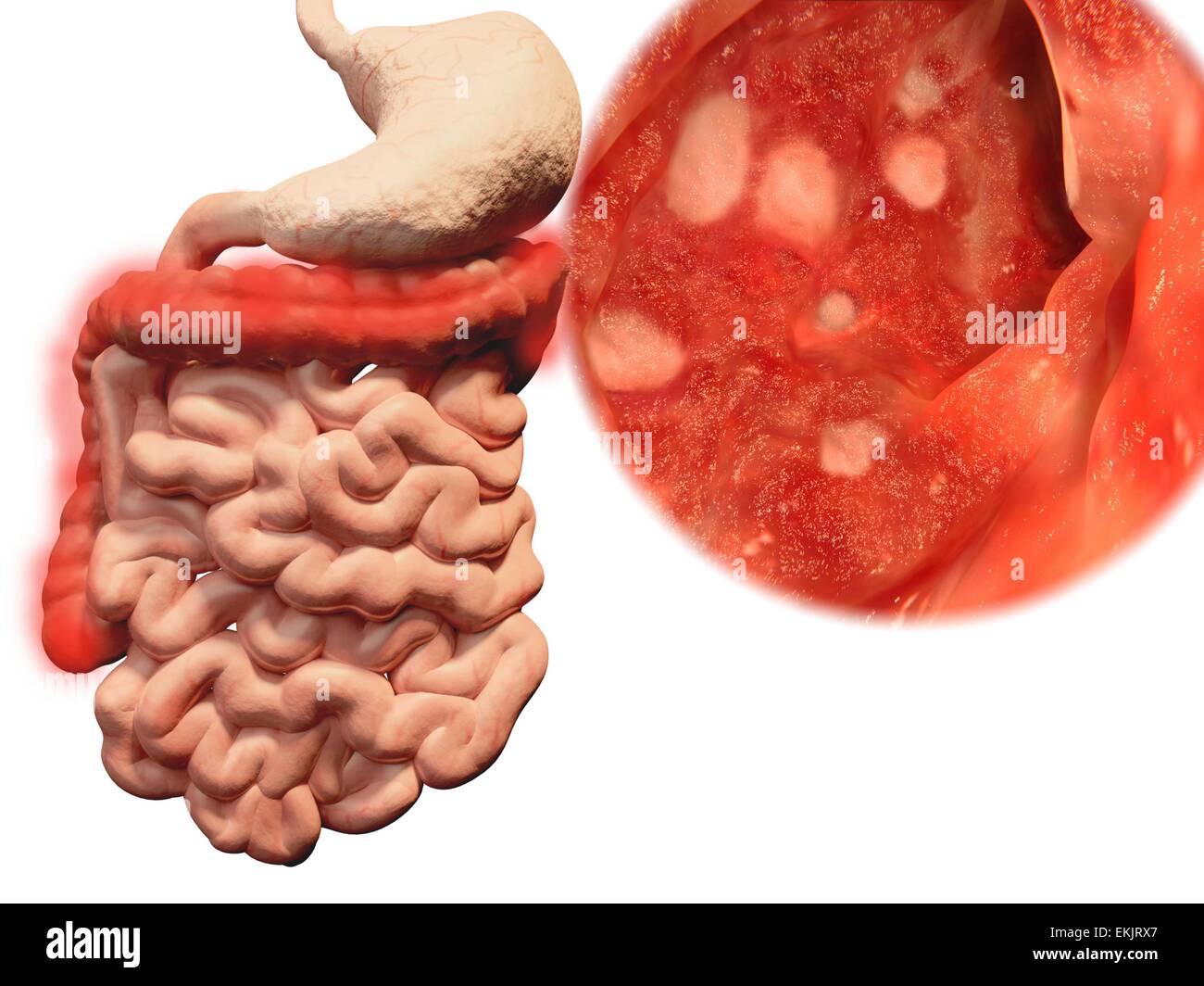 Colitis Ulcerosa: Wenn Der Dickdarm Erkrankt – AQAN