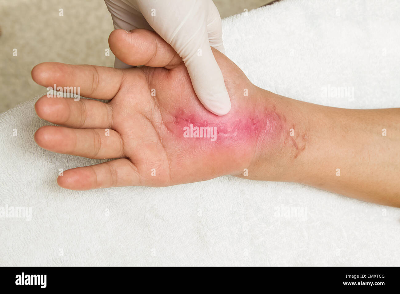 Narbe an hand aufgezogen. Verletzungen der Hand 6 Wochen nach der ...