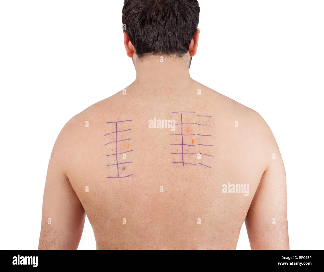Brennnessel dermatitis -Fotos und -Bildmaterial in hoher Auflösung – Alamy