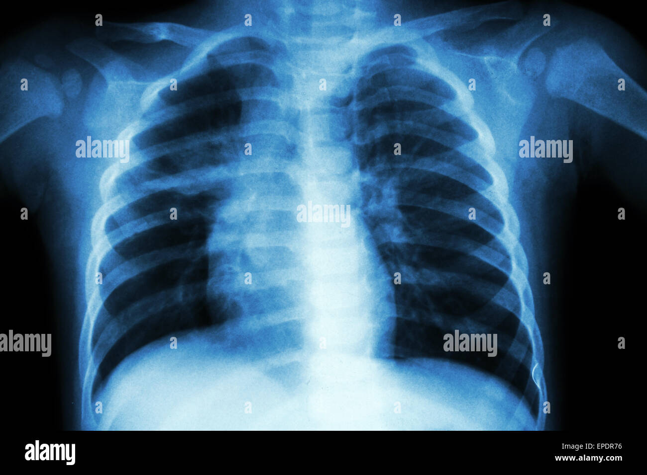 Brust Röntgen Der Lungenerkrankung Stockfotos und -bilder Kaufen - Alamy