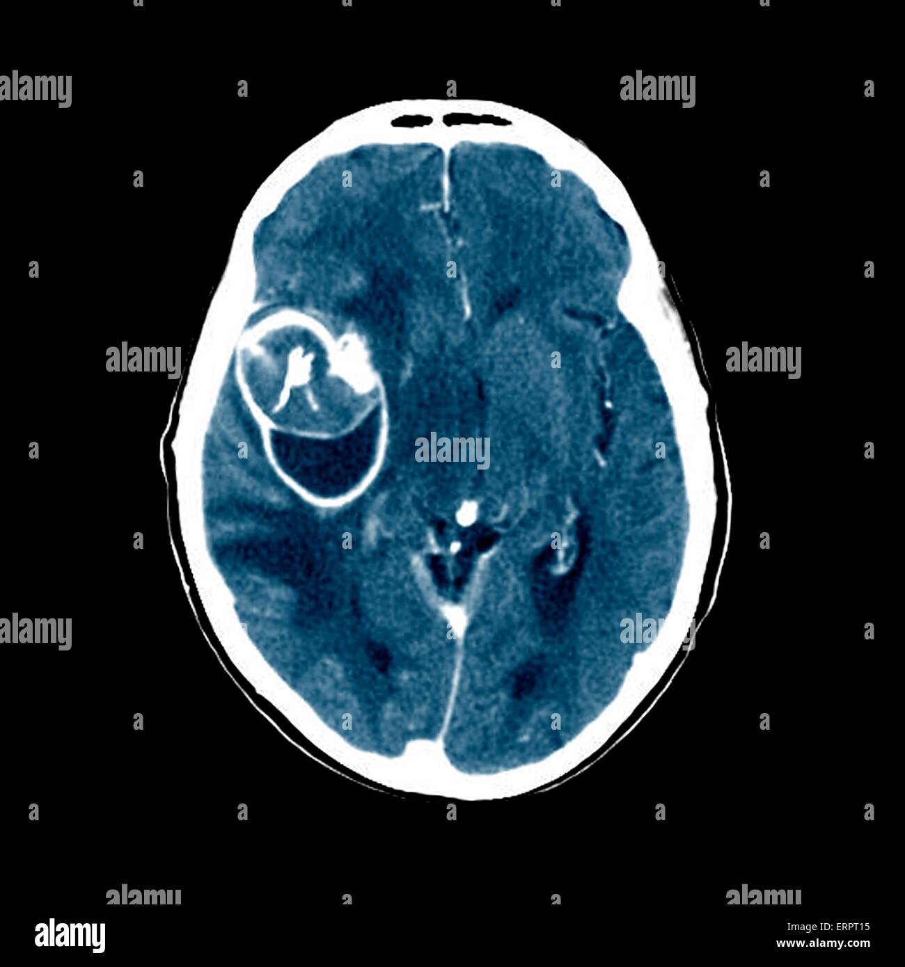 Aneurysma im menschlichen gehirn -Fotos und -Bildmaterial in hoher ...