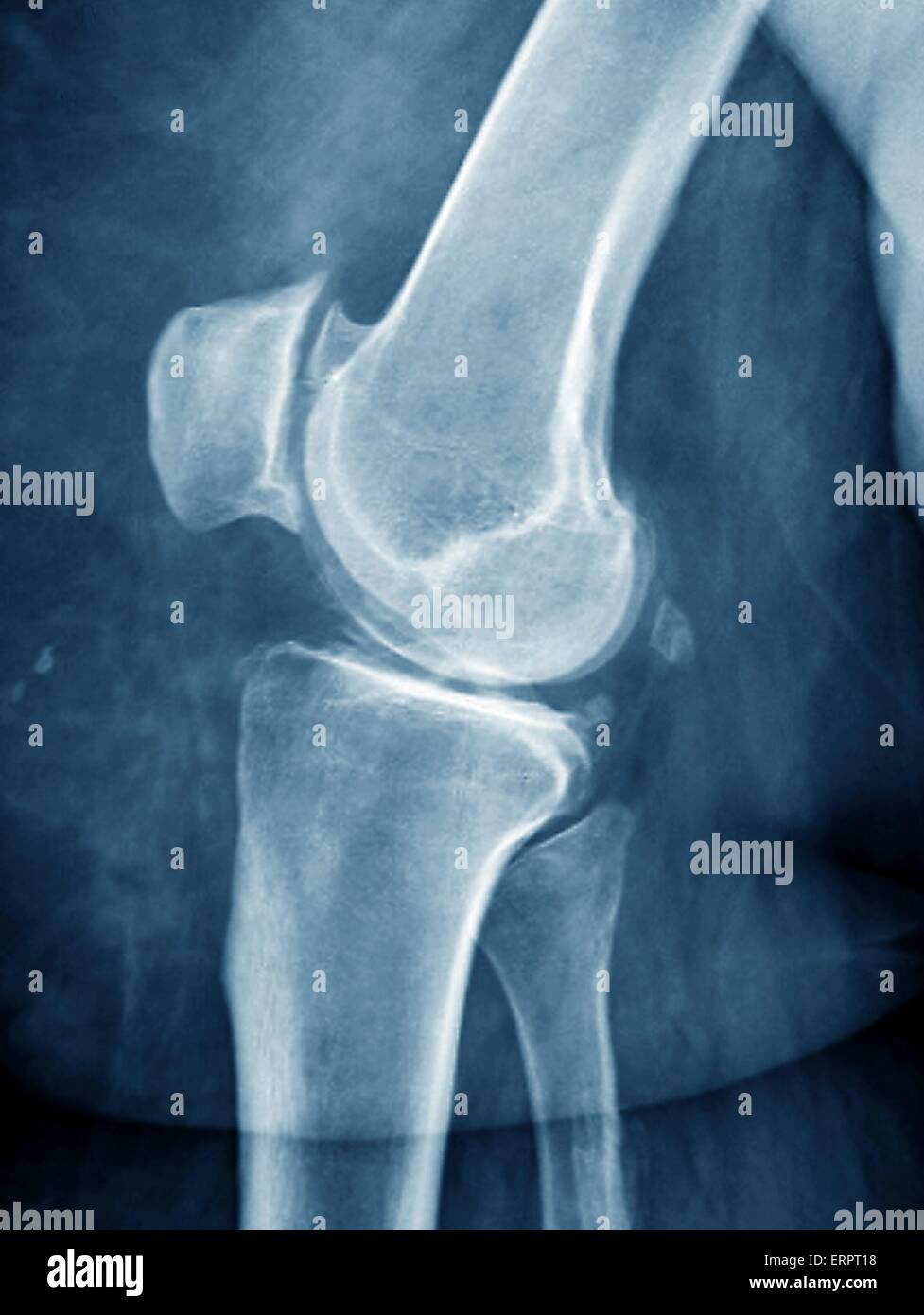 Farbige Profil Röntgen zeigt das rechte Knie eines 46 Jahre alten ...