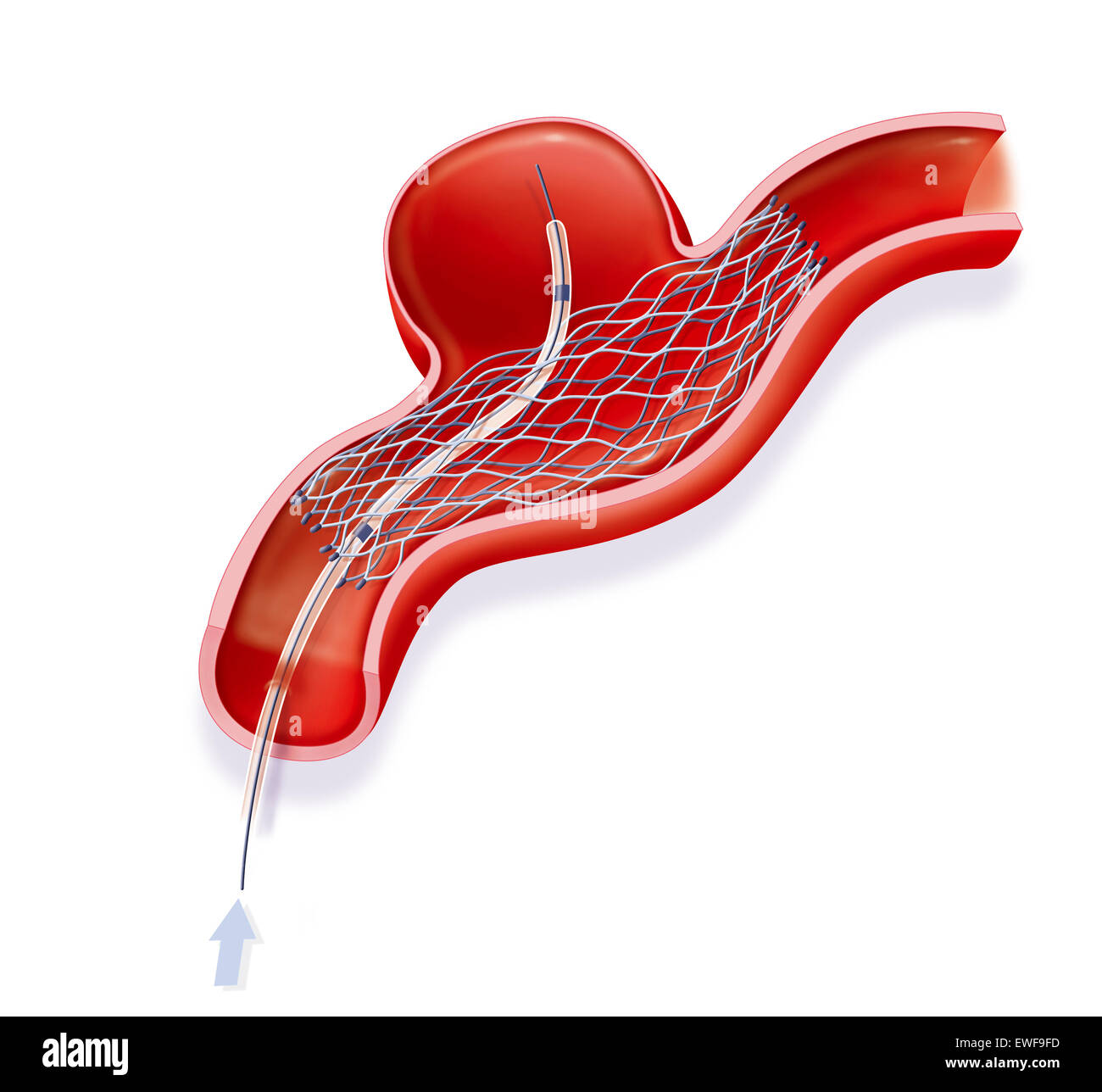 Behandlung von aneurysmen Stockfotos und -bilder Kaufen - Alamy