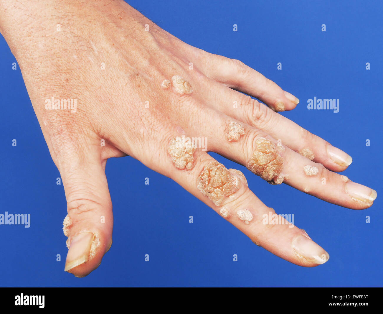 Warzen hand -Fotos und -Bildmaterial in hoher Auflösung - Seite 2 - Alamy
