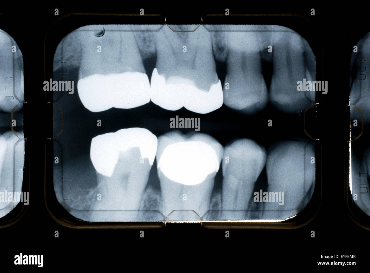 X ray teeth -Fotos und -Bildmaterial in hoher Auflösung – Alamy