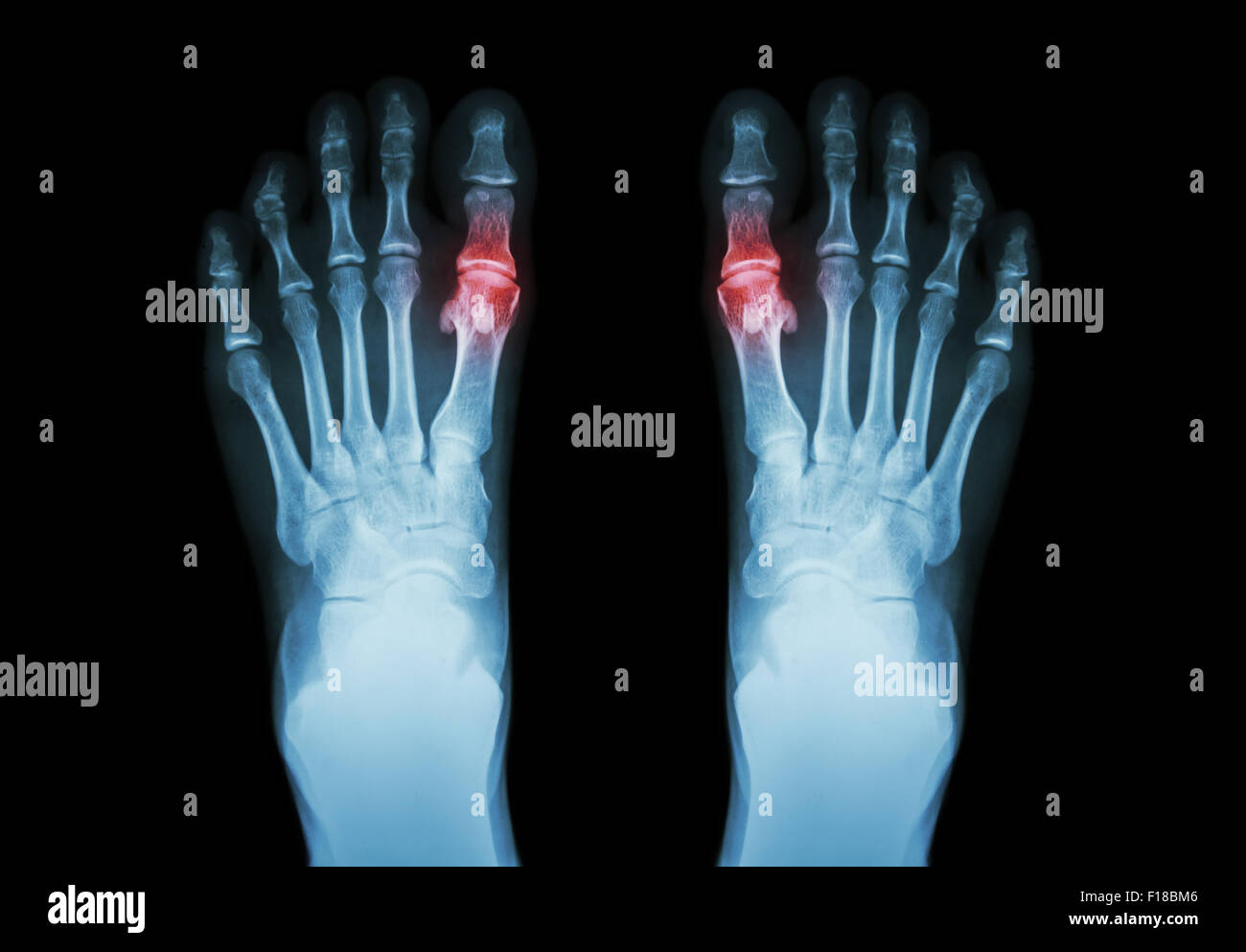Rheumatische arthritis Stockfotos und -bilder Kaufen - Alamy