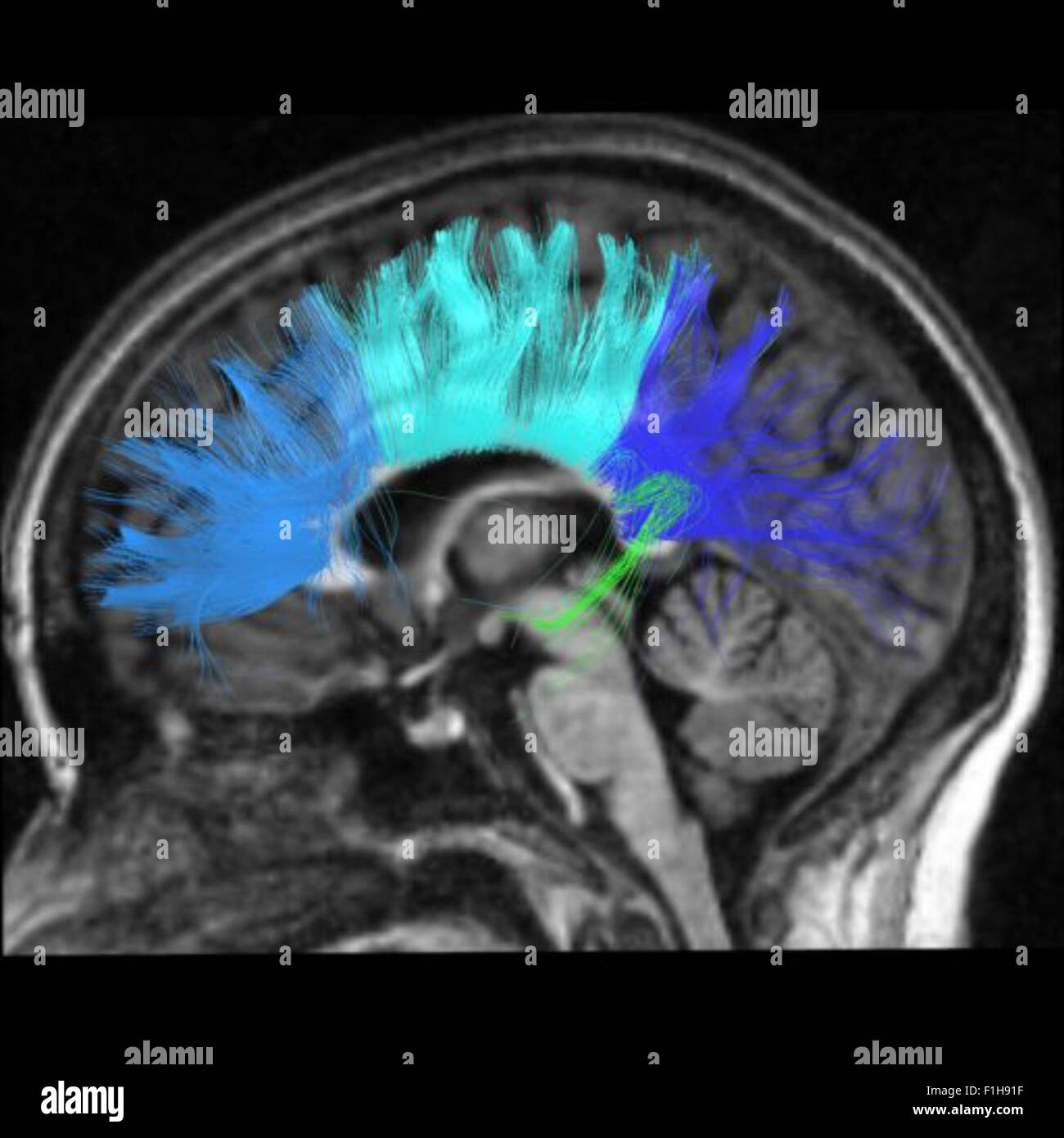 Corpus Callosum Mri Stockfotos und -bilder Kaufen - Alamy