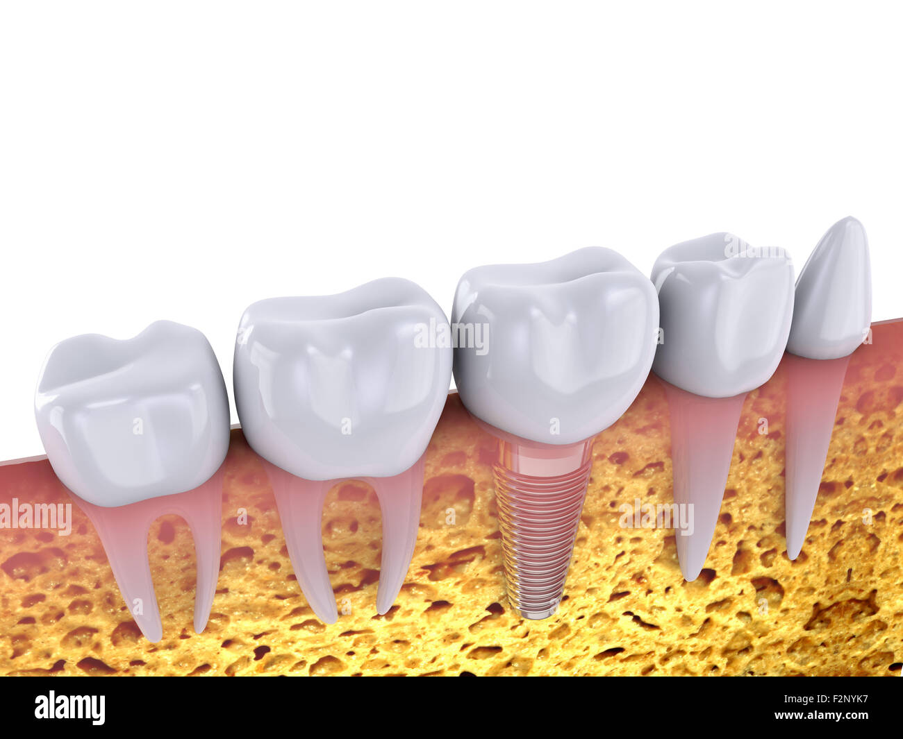 Molaren und Implantat in den Kieferknochen eingesetzt, 3d render ...