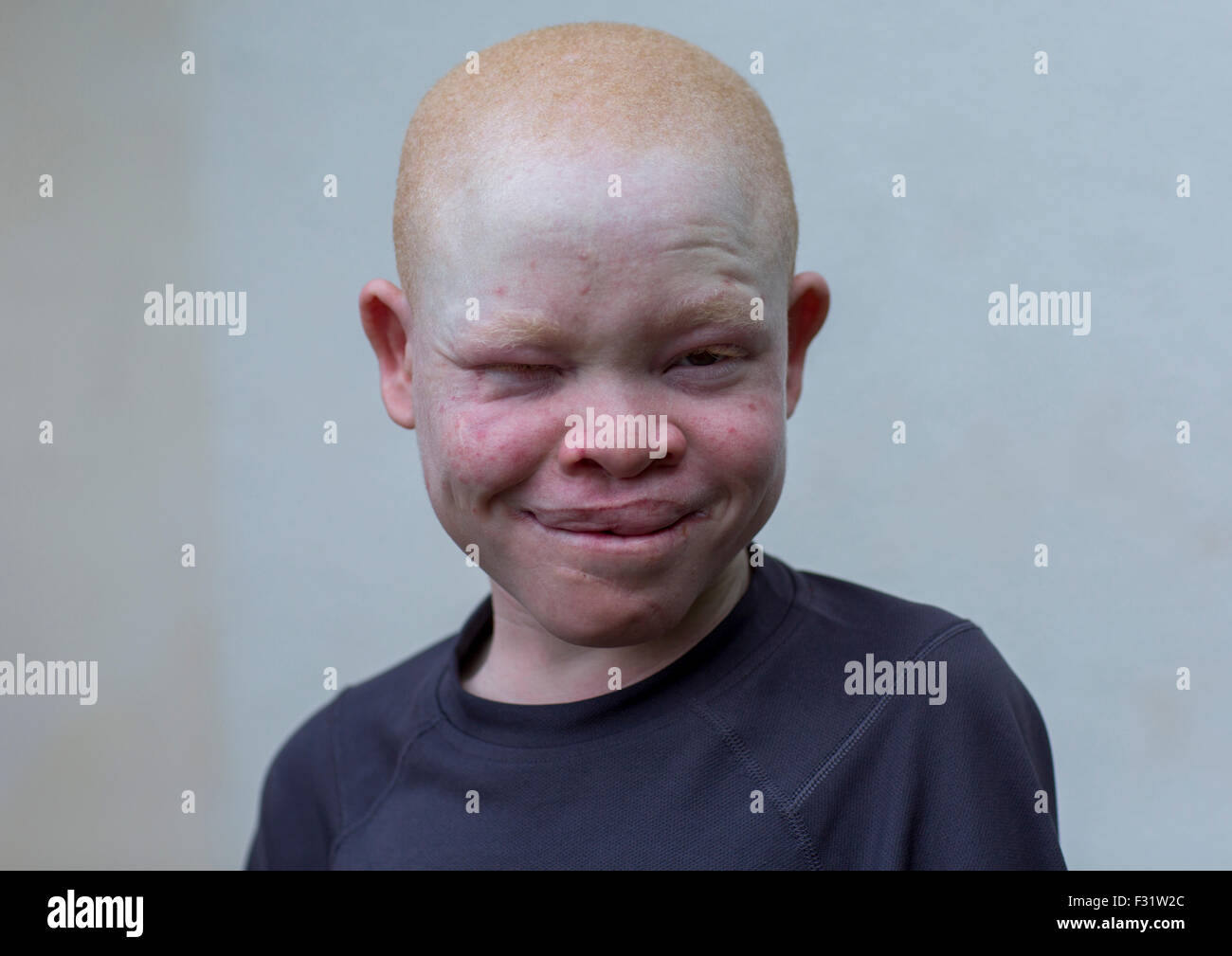 Albinism person africa -Fotos und -Bildmaterial in hoher Auflösung – Alamy