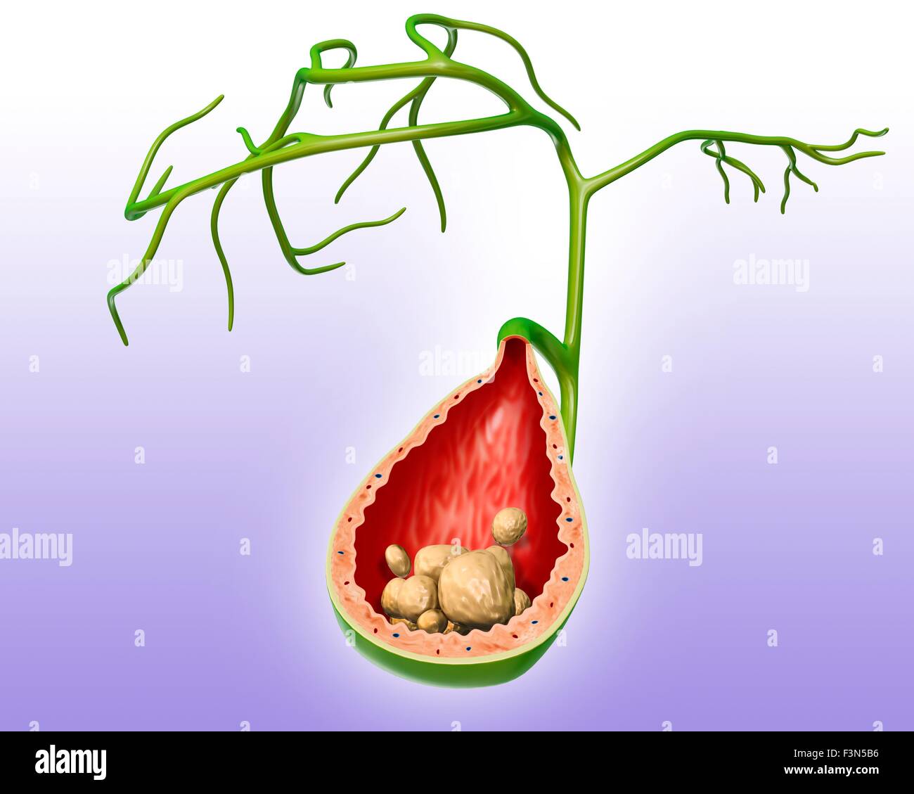 Gall bladder stones -Fotos und -Bildmaterial in hoher Auflösung – Alamy