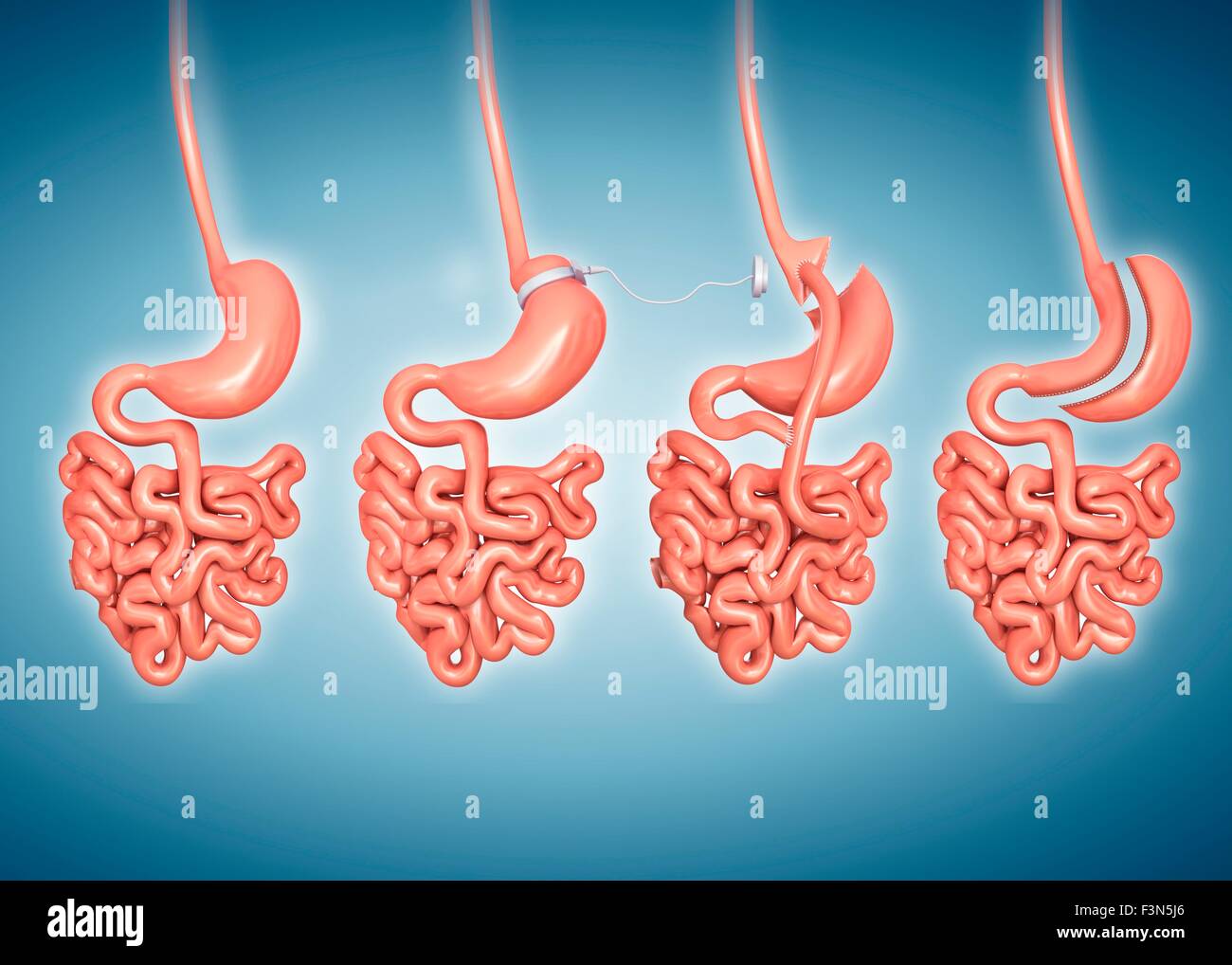 Roux en y magenbypass bariatrische chirurgie -Fotos und -Bildmaterial ...