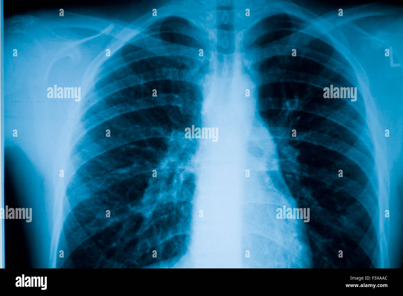 Thorax brustkorb -Fotos und -Bildmaterial in hoher Auflösung – Alamy