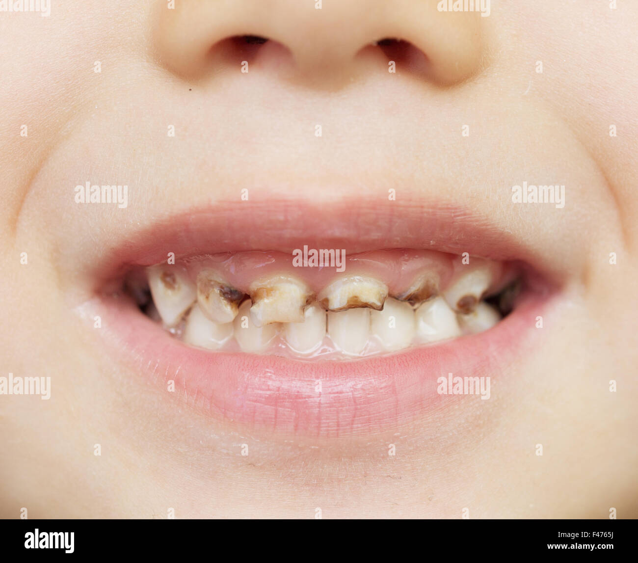 Schlechte zähne -Fotos und -Bildmaterial in hoher Auflösung – Alamy