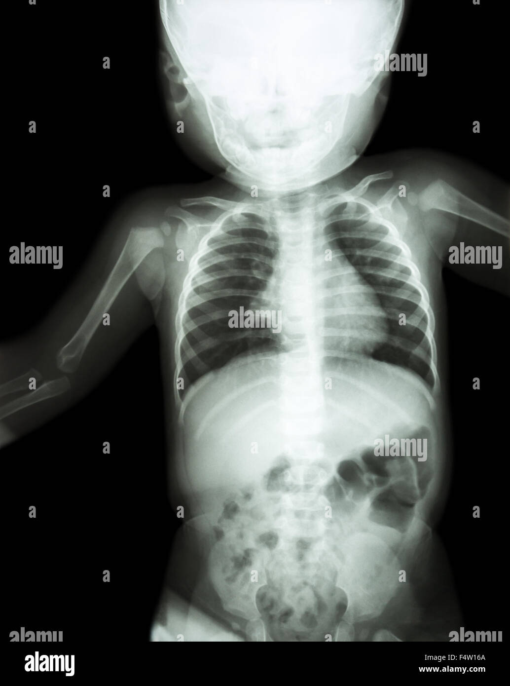 Film x-ray kindlichen Körper (normales Baby Stockfotografie - Alamy