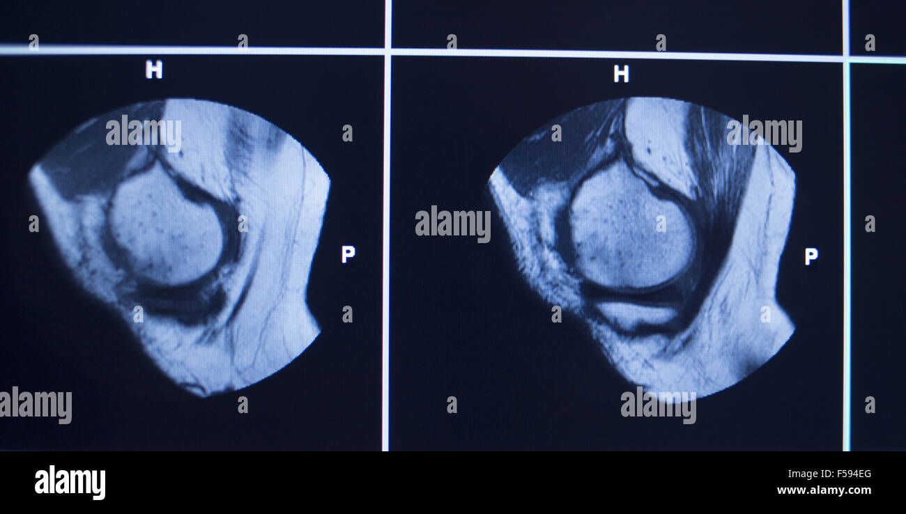 Mri des meniskus -Fotos und -Bildmaterial in hoher Auflösung – Alamy