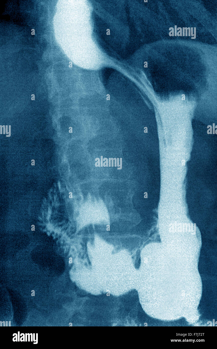 MAGEN, X-RAY Stockfotografie - Alamy