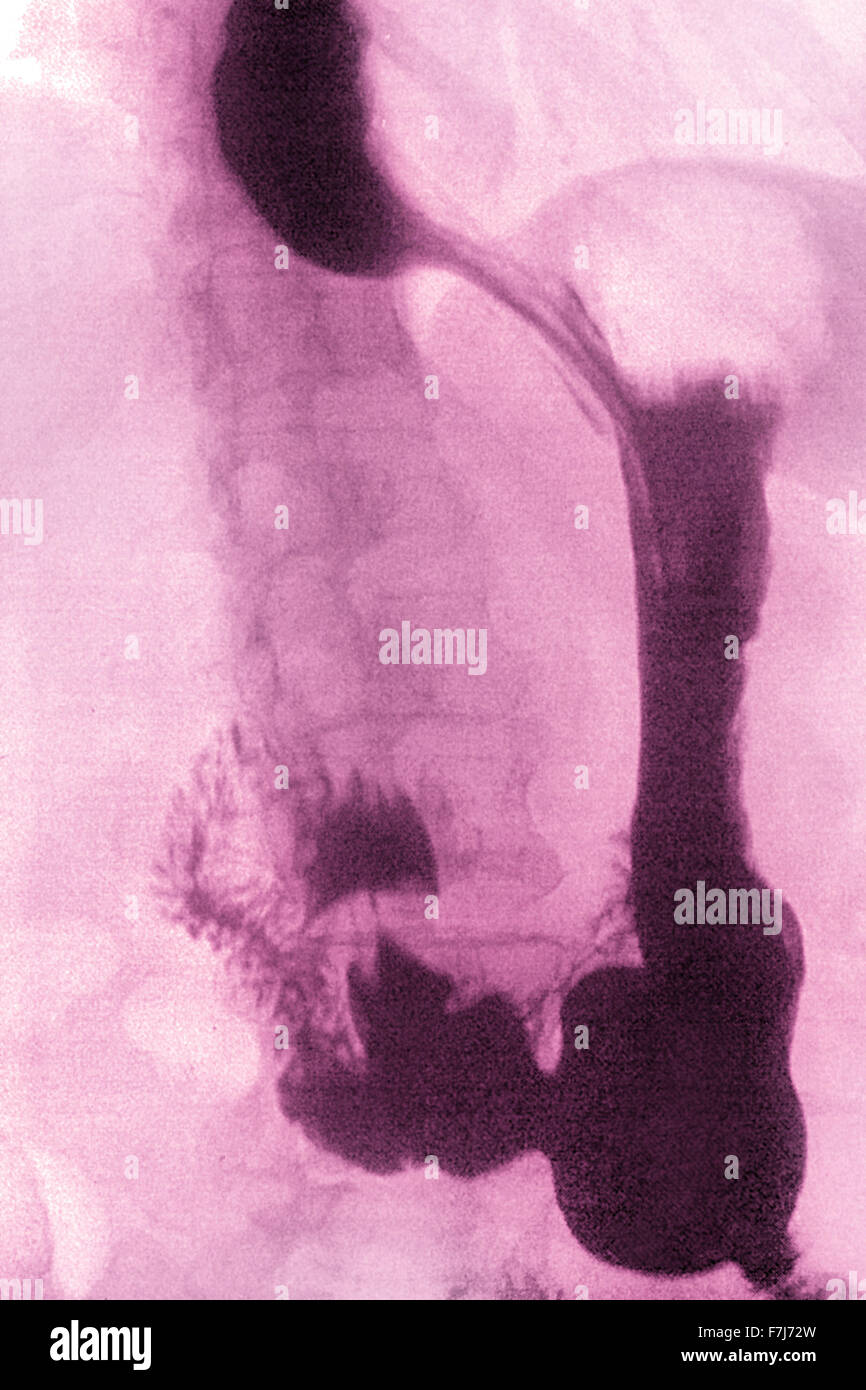 Magen darm trakt -Fotos und -Bildmaterial in hoher Auflösung – Alamy