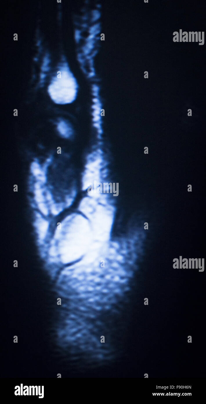 MRT Magnet-Resonanz-Tomographie medizinische Scan Testergebnisse zeigen ...