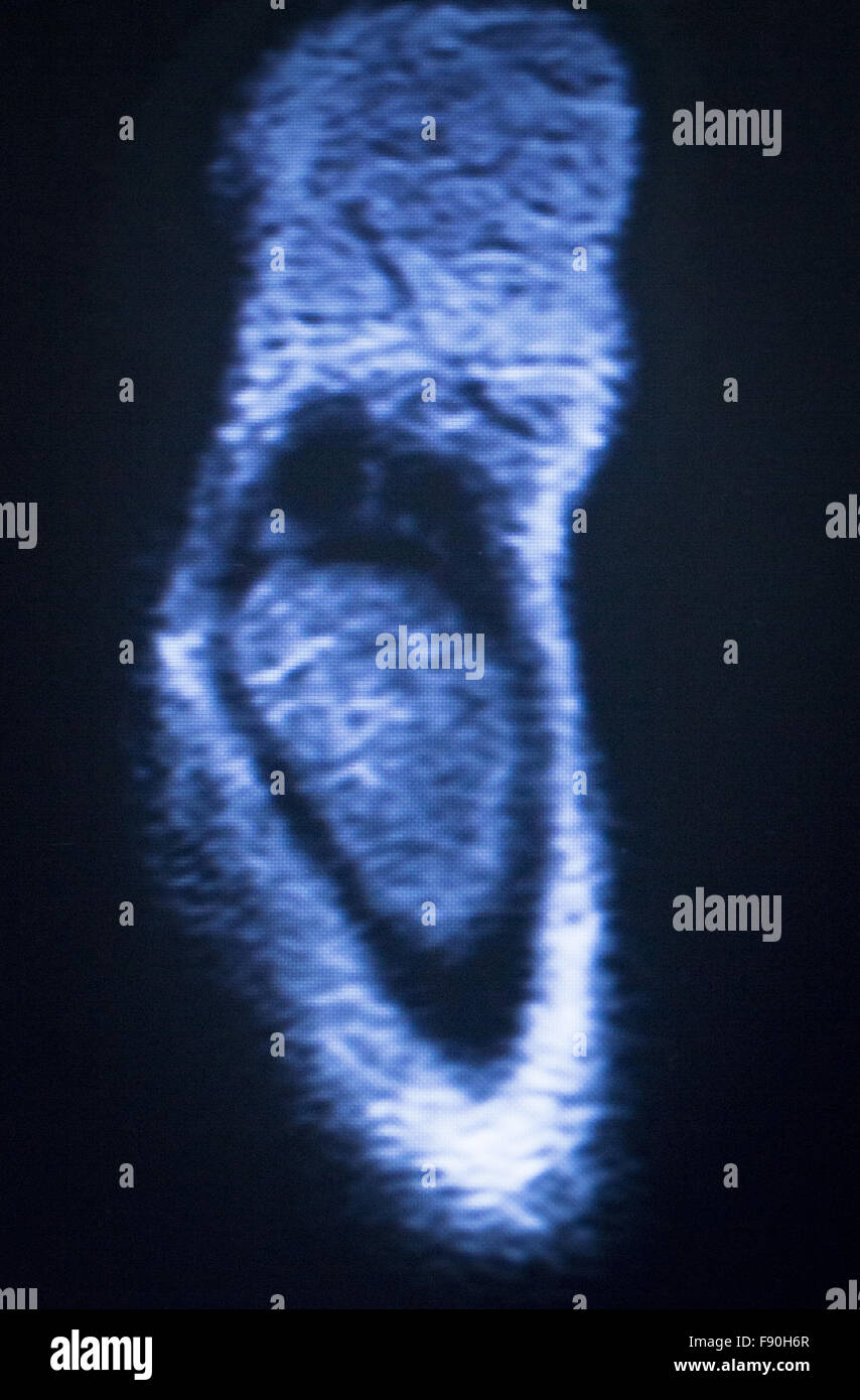 MRT Magnet-Resonanz-Tomographie medizinische Scan Ellenbogen ...