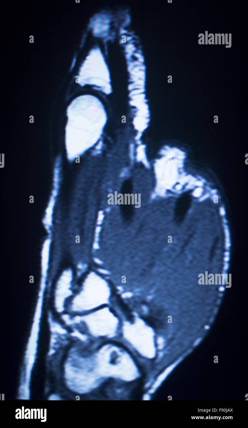 MRT Magnet-Resonanz-Tomographie medizinischen Test Scanergebnisse mit ...