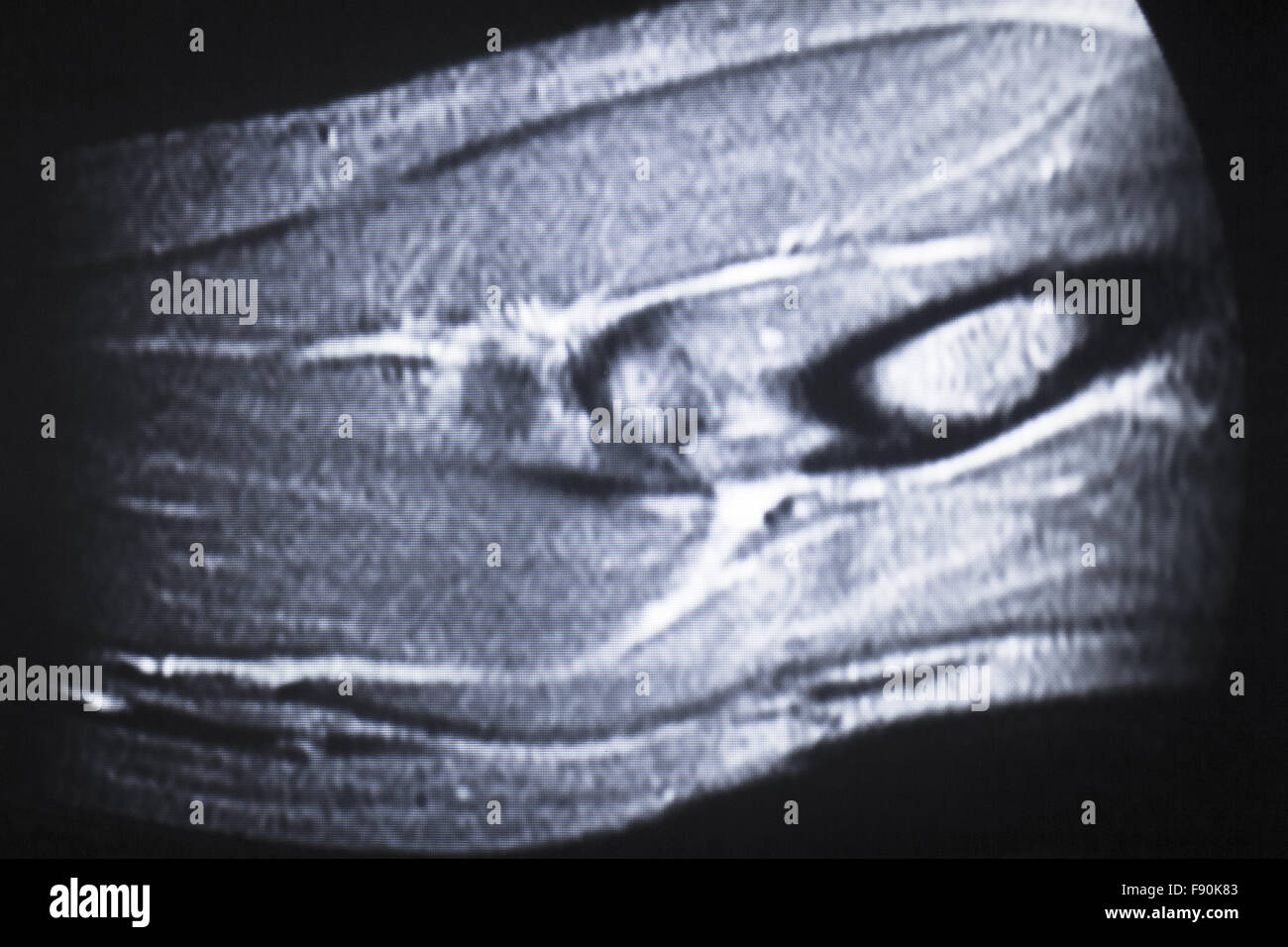 MRT Magnet-Resonanz-Tomographie medizinische Scan Ellenbogen ...
