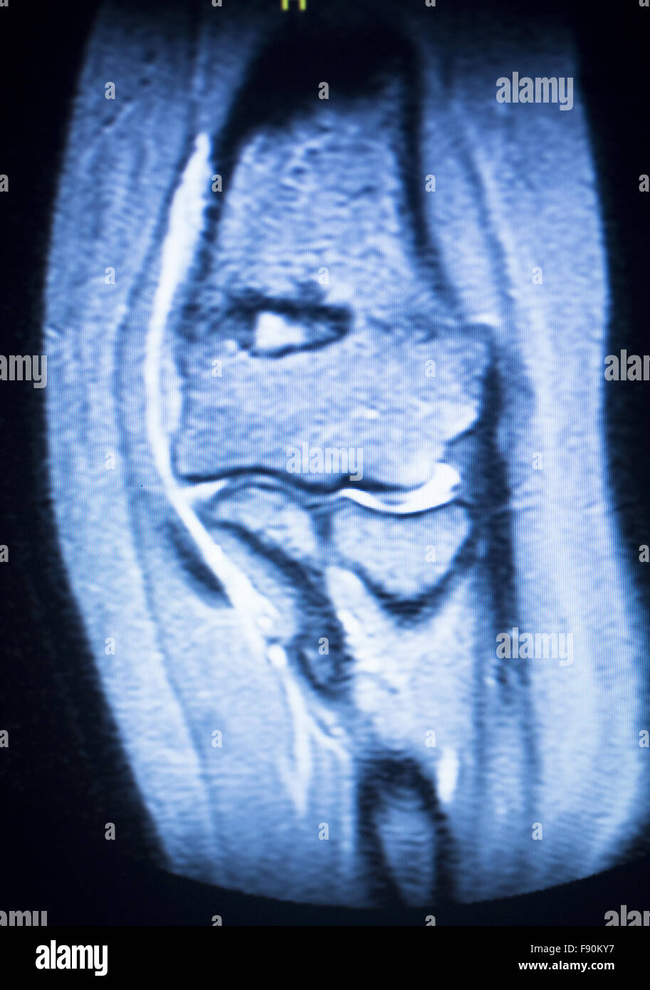 MRT Magnet-Resonanz-Tomographie medizinische Scan Ellenbogen ...