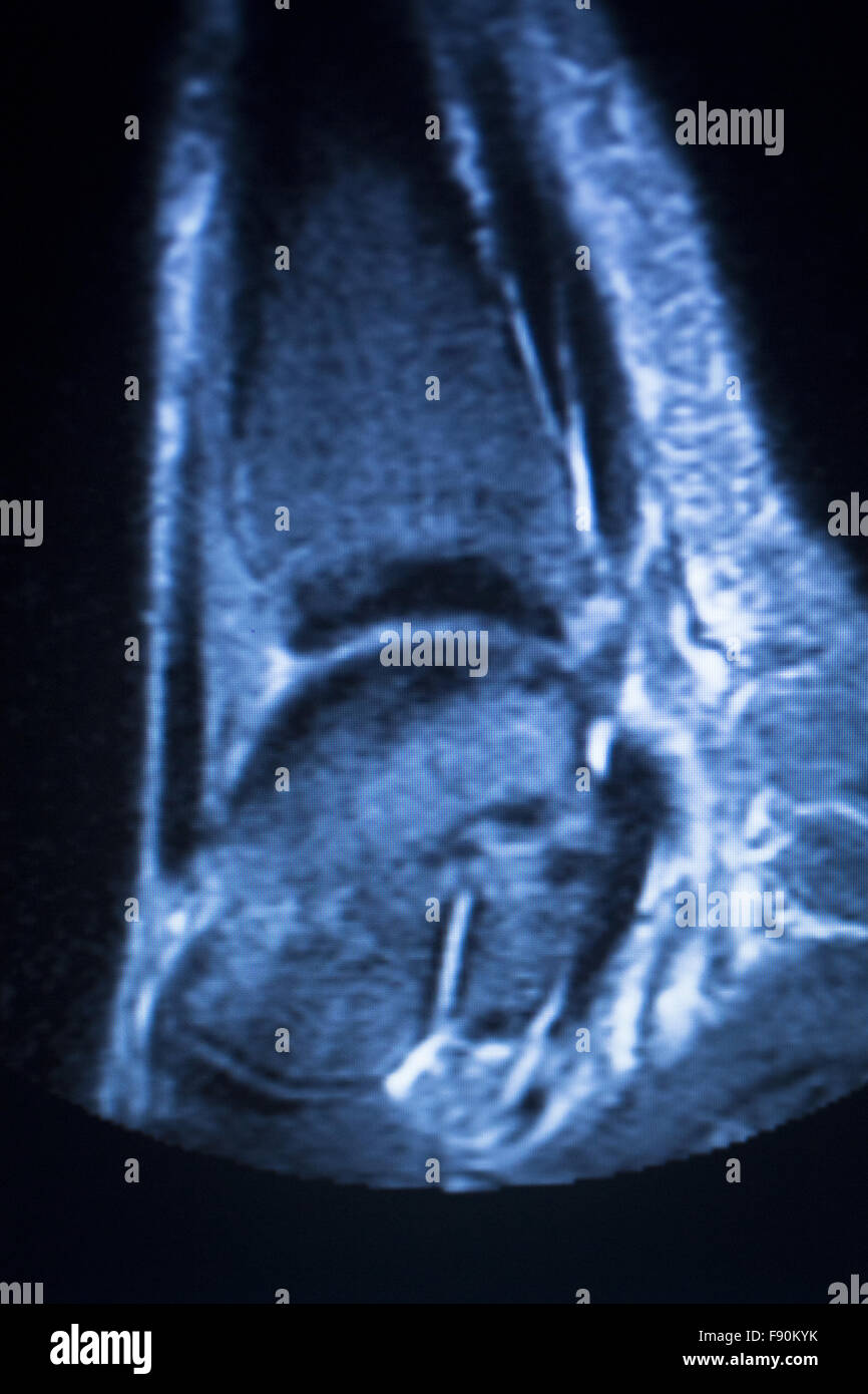 MRT Magnet-Resonanz-Tomographie medizinischen Test Scanergebnisse mit ...
