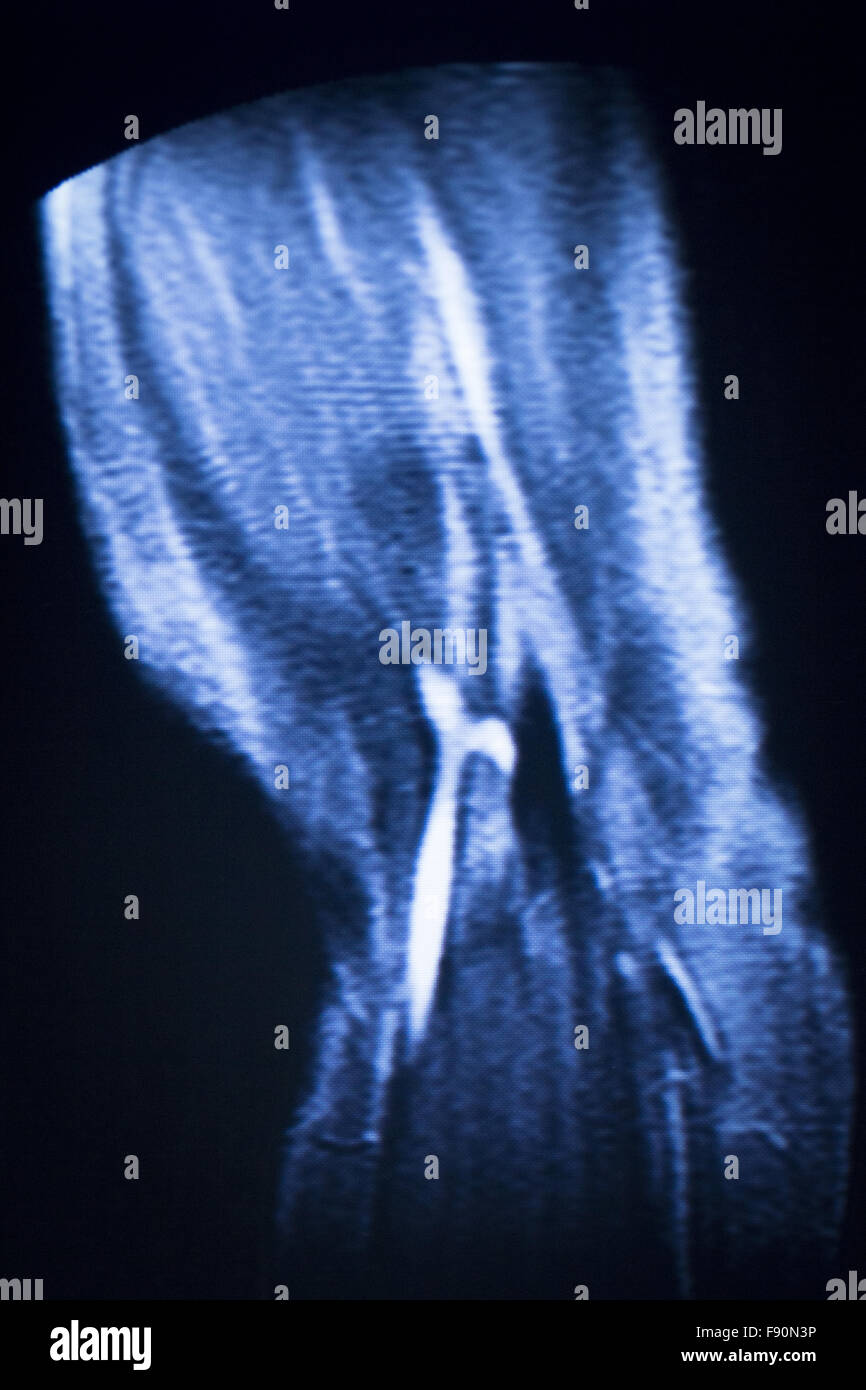 MRT Magnet-Resonanz-Tomographie medizinische Scan Ellenbogen ...
