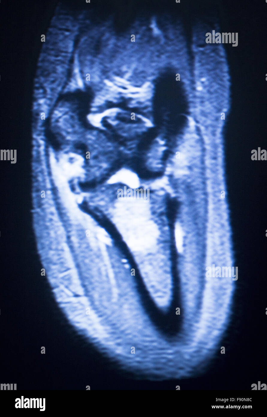 MRT Magnet-Resonanz-Tomographie medizinische Scan Ellenbogen ...