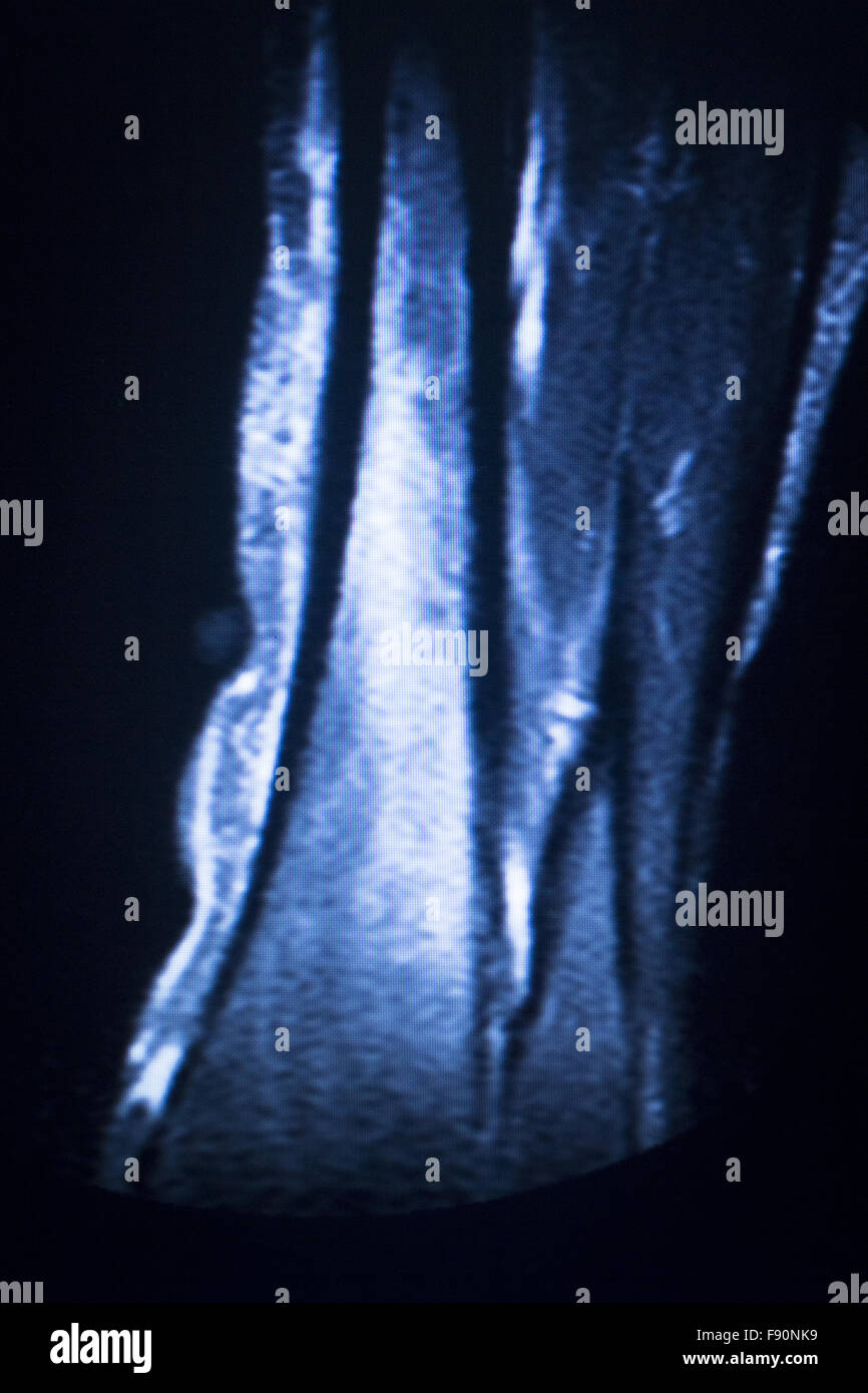 MRT Magnet-Resonanz-Tomographie medizinischen Test Scanergebnisse mit ...