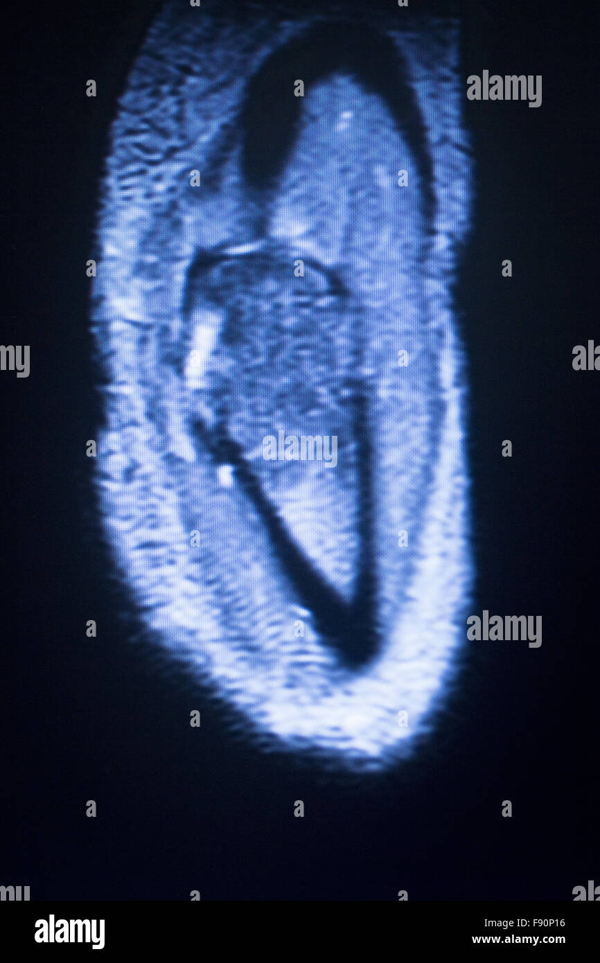 MRT Magnet-Resonanz-Tomographie medizinische Scan Ellenbogen ...