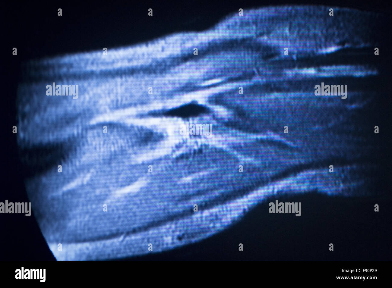 MRT Magnet-Resonanz-Tomographie medizinische Scan Ellenbogen ...