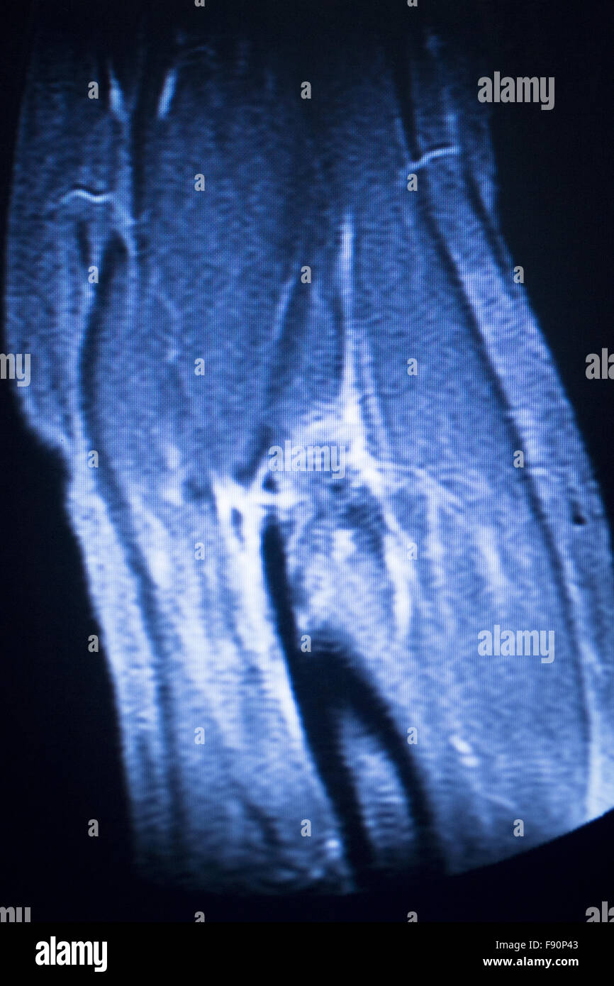 MRT Magnet-Resonanz-Tomographie medizinische Scan Ellenbogen ...