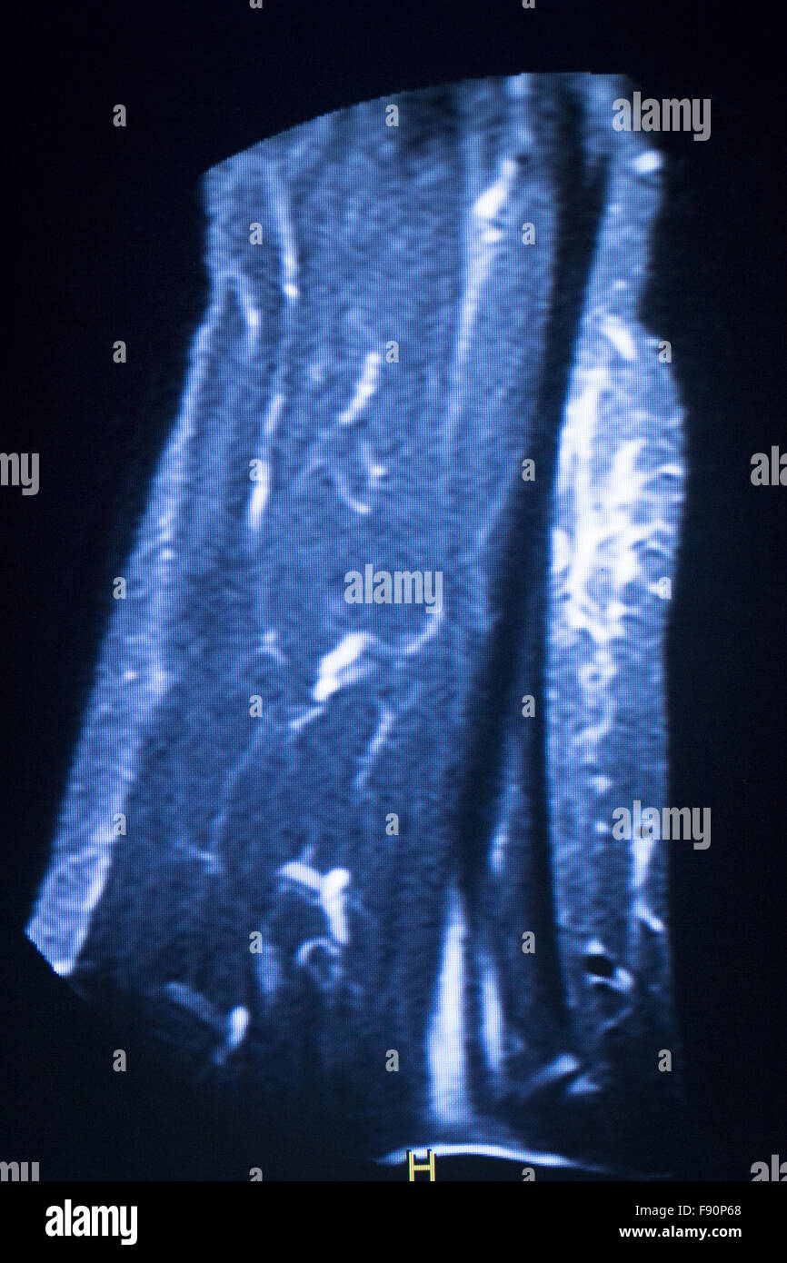 MRT Magnet-Resonanz-Tomographie medizinischen Test Scanergebnisse mit ...