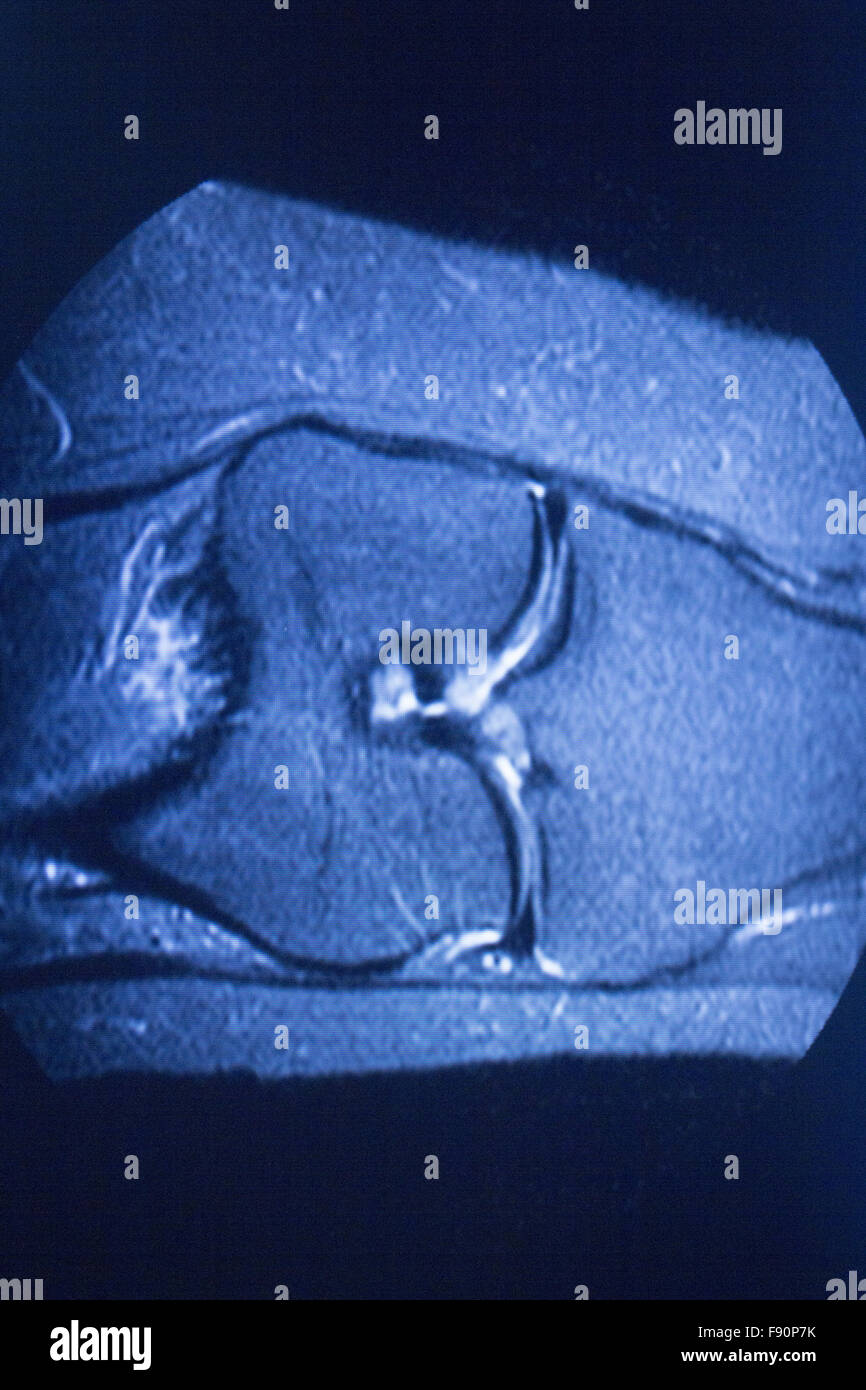 MRT Magnet-Resonanz-Tomographie medizinischen Test Scanergebnisse mit ...