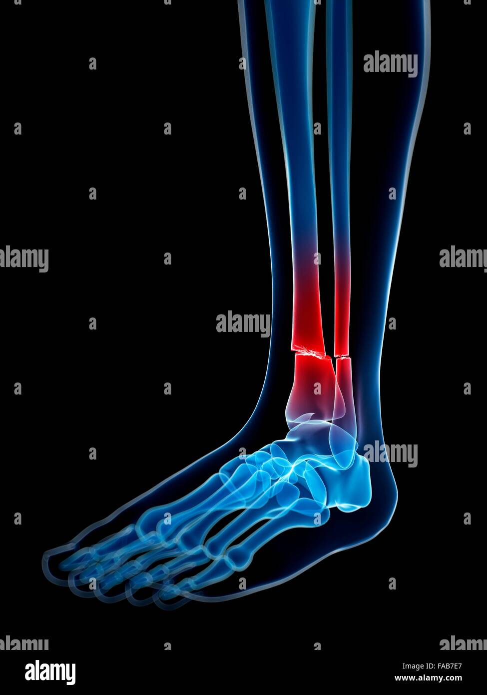 Gebrochene unterschenkelknochen -Fotos und -Bildmaterial in hoher ...
