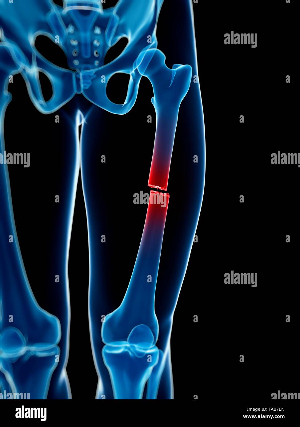 Oberschenkel Knochenbruch, Computer Bild Stockfotografie - Alamy