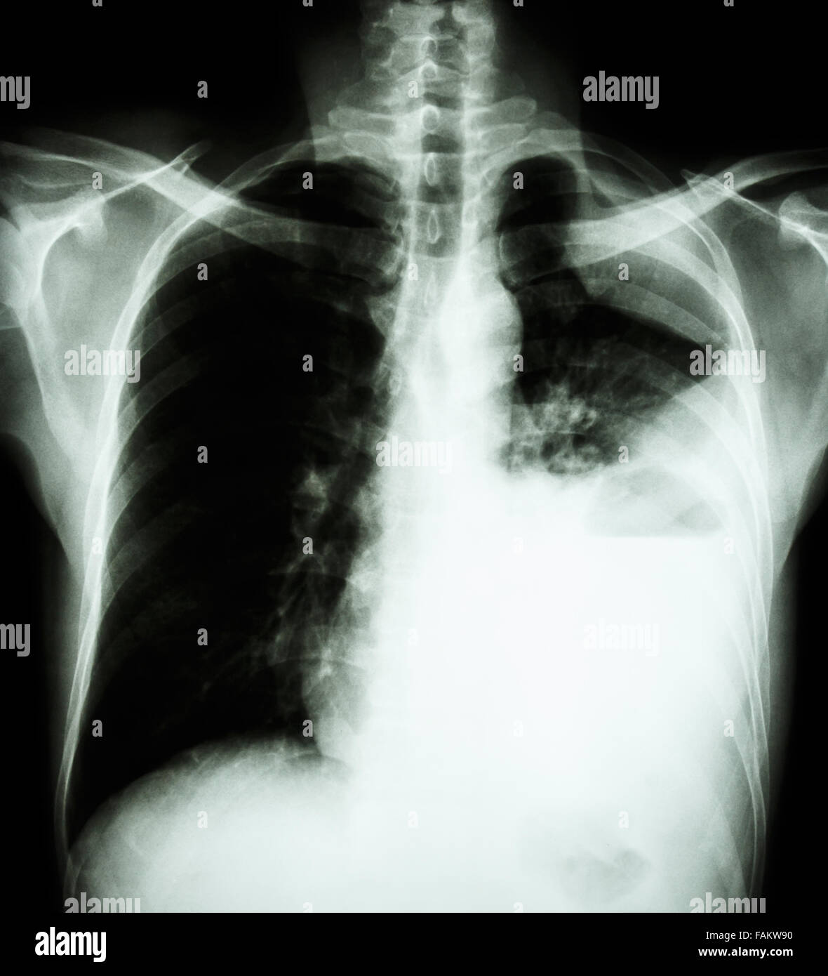 Lungenkrebs (Film Röntgen der Brust PA aufrecht: show Pleuraerguss im ...