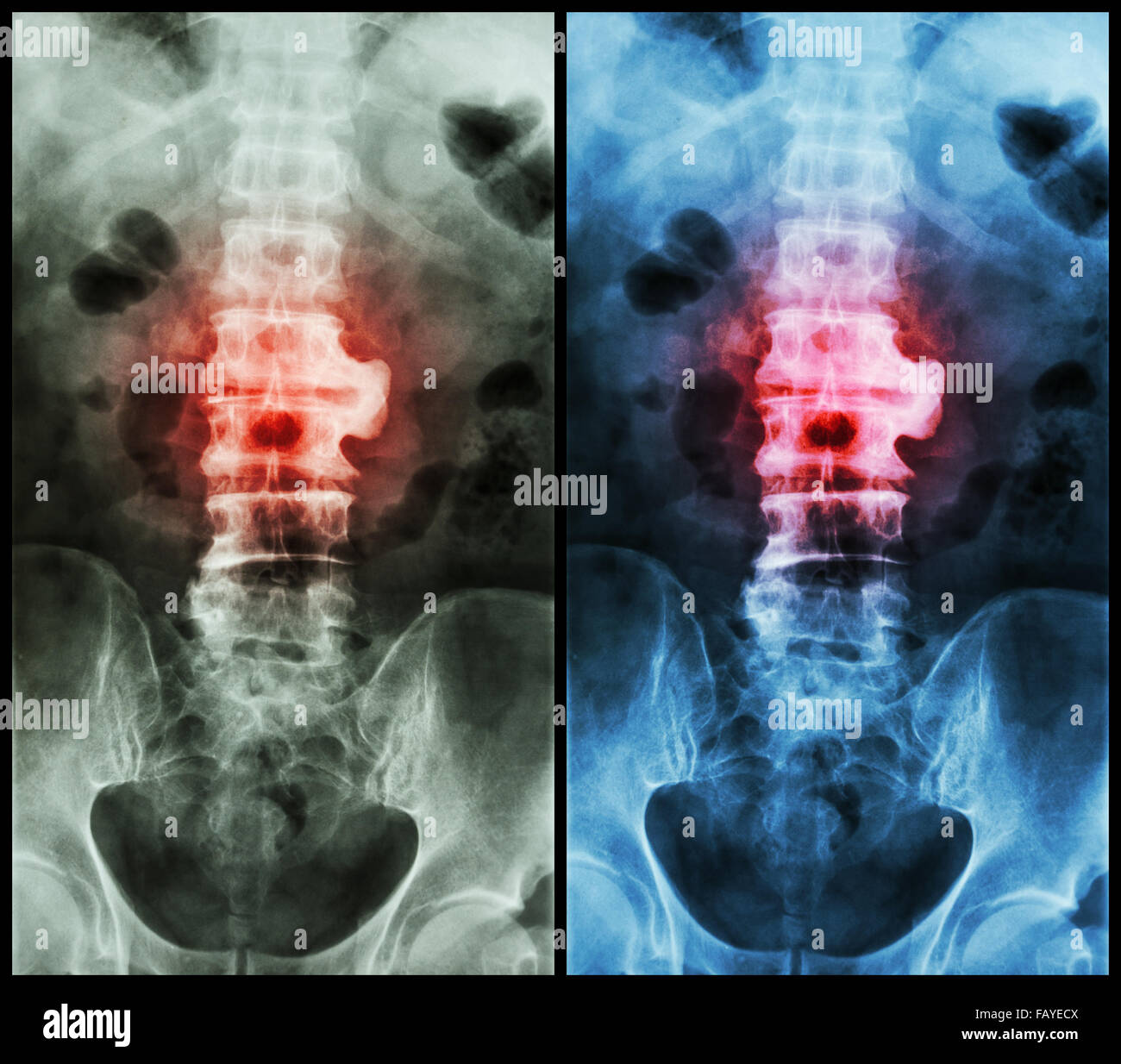 Spondylose (Film Röntgen Lumbo - sakrale Wirbelsäule: show Spondylose ...