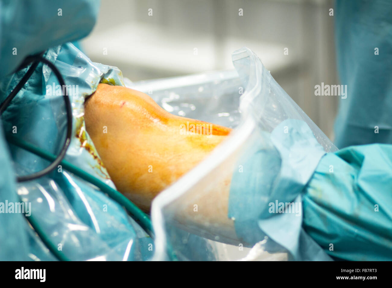 Operation meniskus -Fotos und -Bildmaterial in hoher Auflösung – Alamy