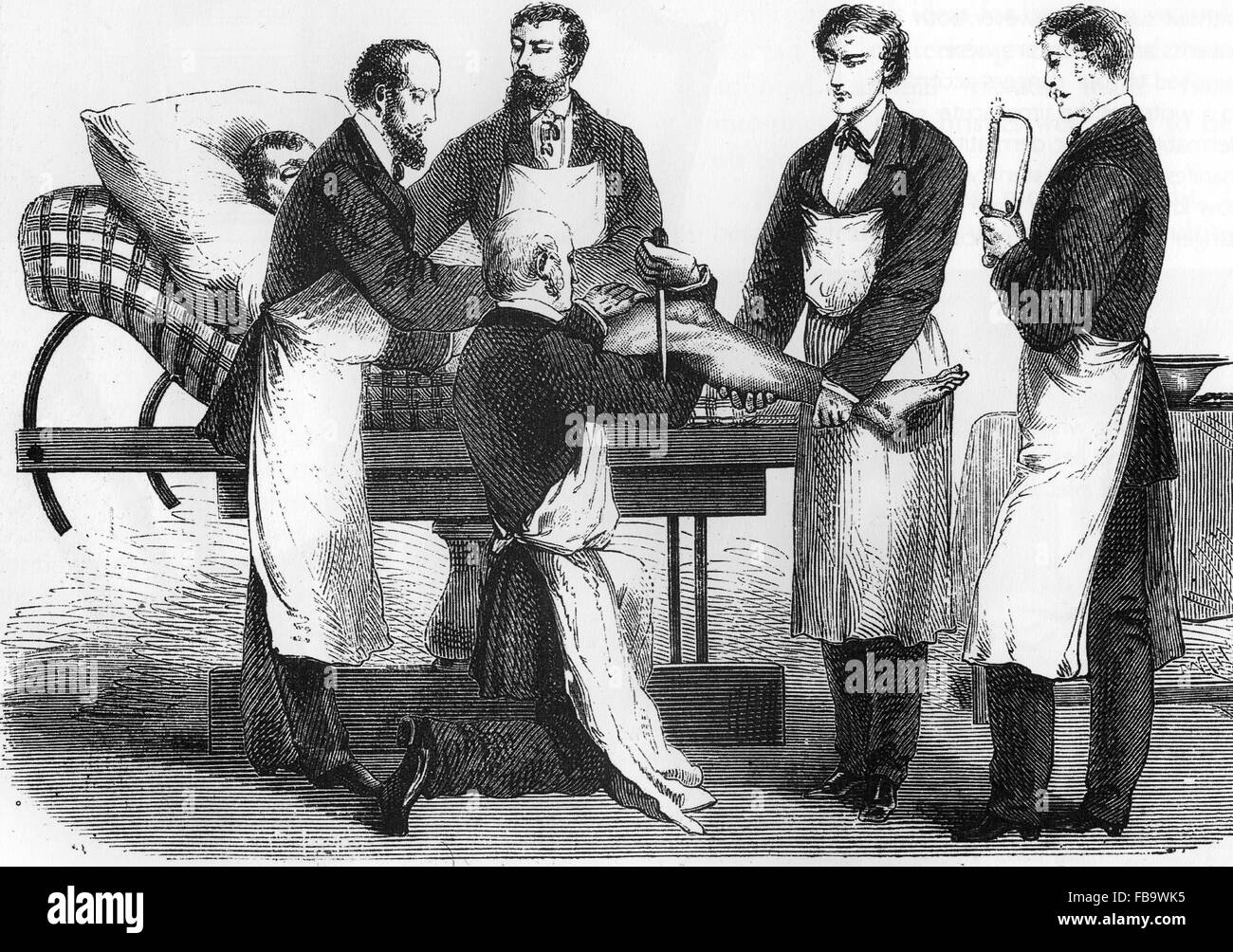 Amputation 19th Century Stockfotos und -bilder Kaufen - Alamy