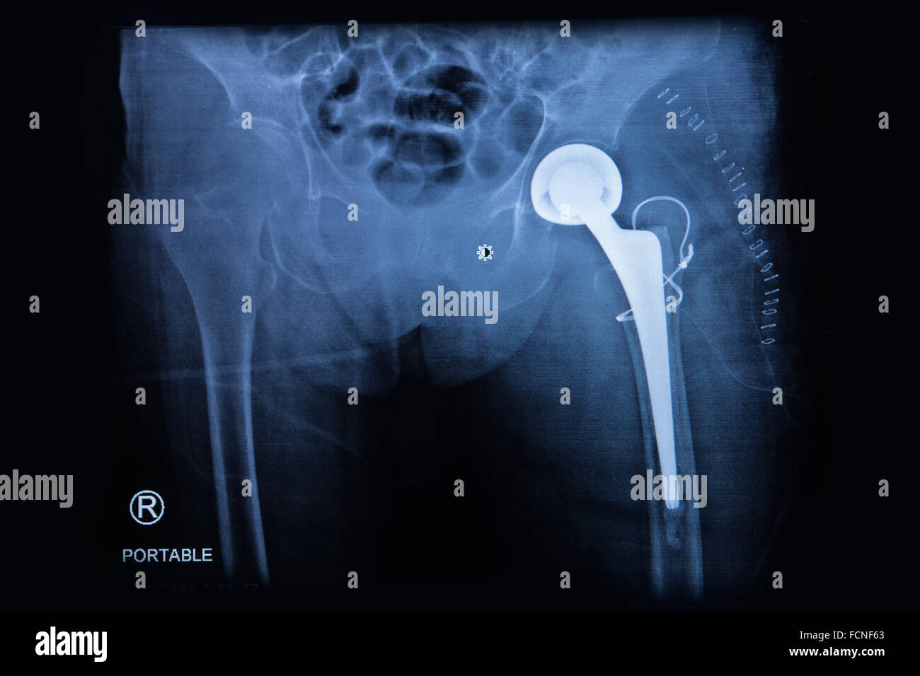 Röntgen der Hüfte Endoprothese in Seniorin, Hüftgelenkersatz Stockfotografie - Alamy