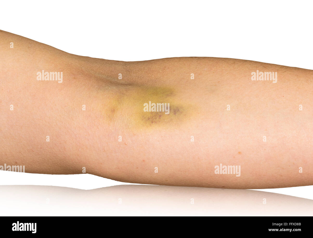 Skin trauma -Fotos und -Bildmaterial in hoher Auflösung – Alamy