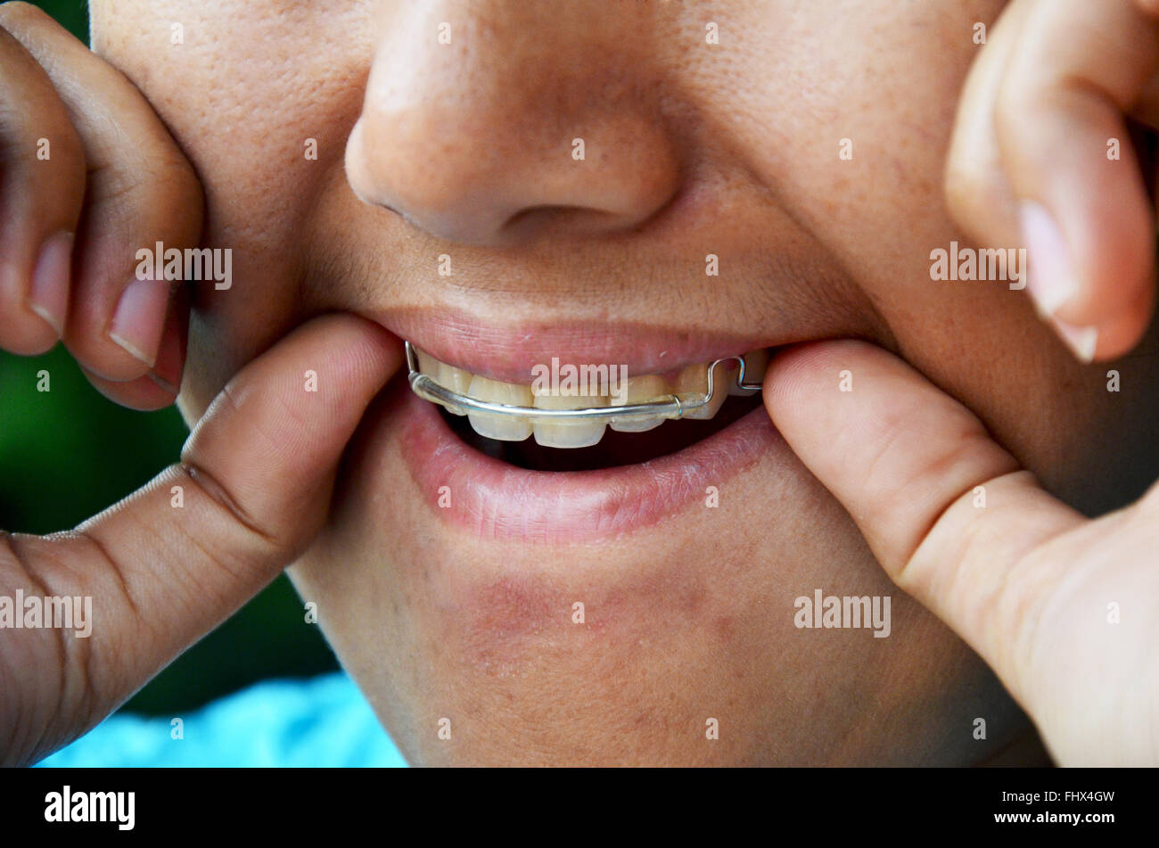 Thai girl braces -Fotos und -Bildmaterial in hoher Auflösung – Alamy