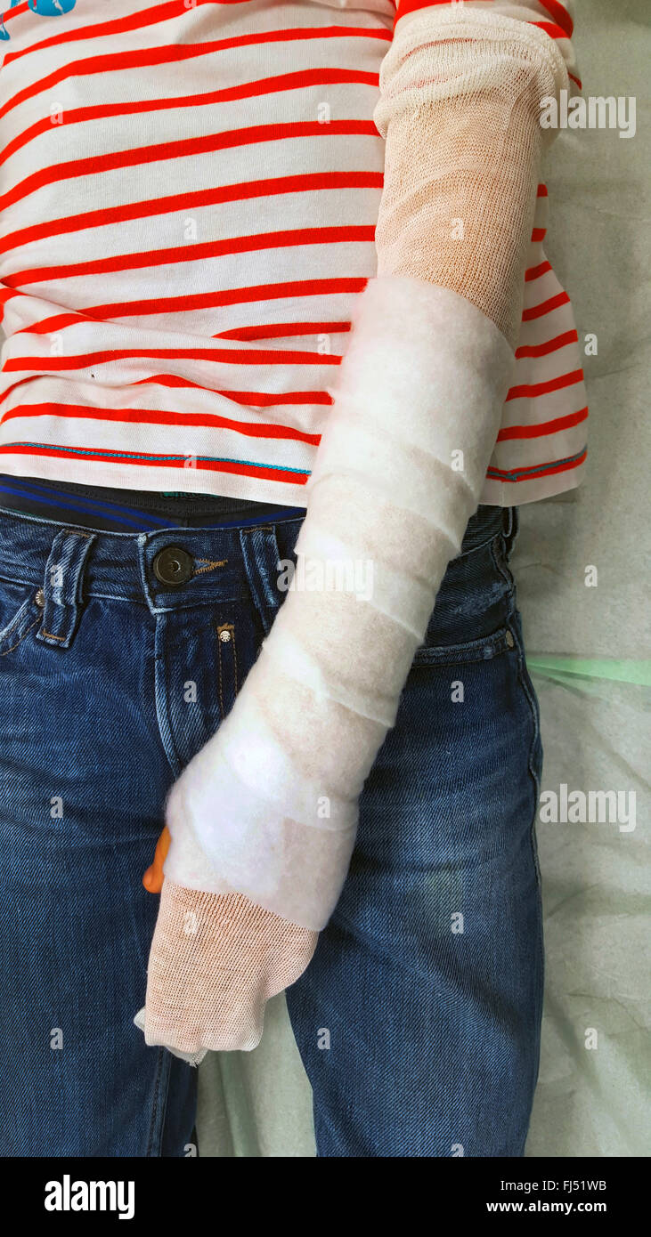 Handgelenk Fraktur ist Arm, verputzt, Vorbereitung Stockfotografie - Alamy