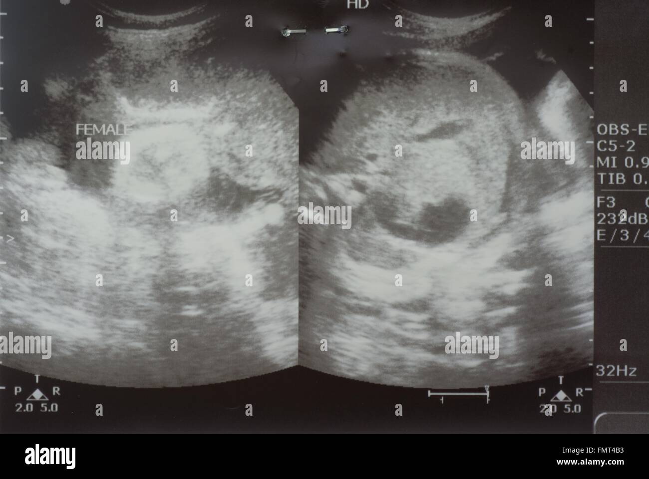 Ultraschall ultraschall -Fotos und -Bildmaterial in hoher Auflösung – Alamy
